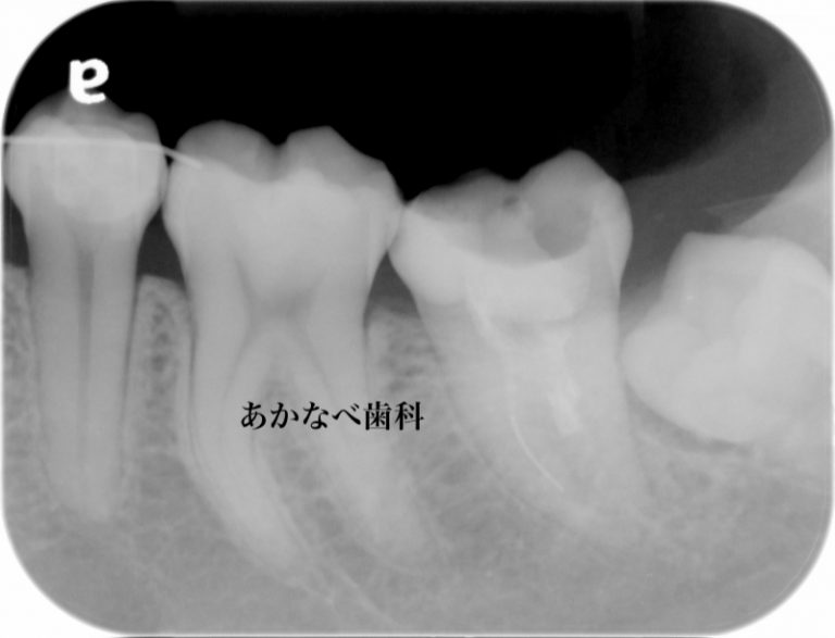 左下7 Previously Treated / Normal Apical Tissues